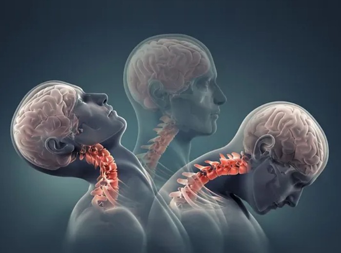 Whiplash Associated Disorders (WAD) - ALGOS Multispecialty Pain Clinic