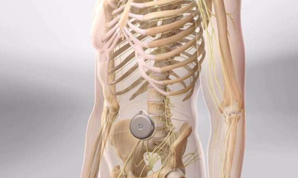 Intrathecal Pump - ALGOS Multispecialty Pain Clinic
